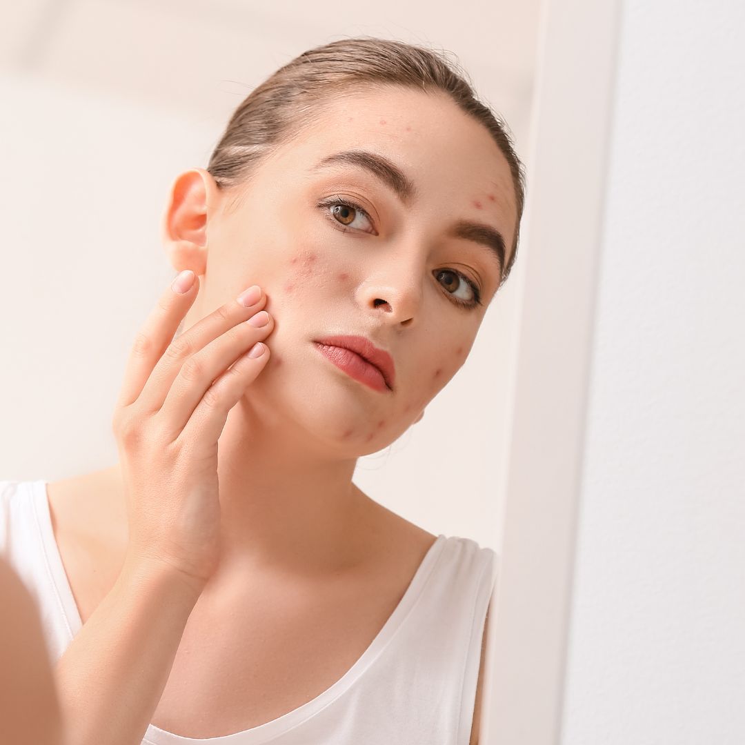 Skincare Anti Brufoli Lovves il migliore trattamento completo anti ...